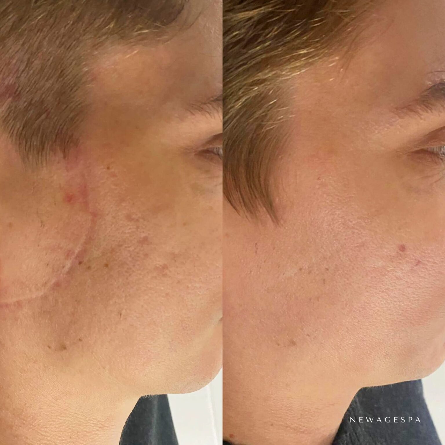 What is Dermapen DP4? Advanced Microneedling