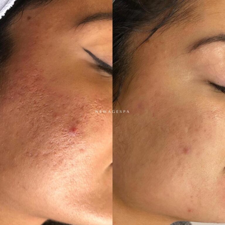 Top 7 Skin Concerns the Dermapen DP4 Can Treat Effectively - NEW AGE SPA